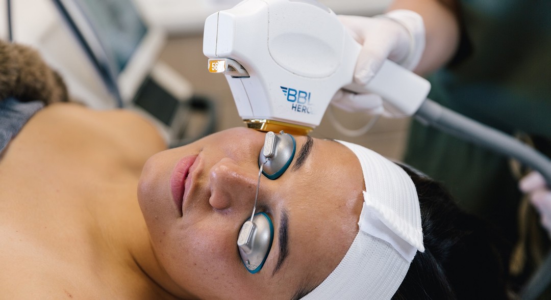 BBL Laser Treatment Salt Lake City | Rise Rejuvenation Center